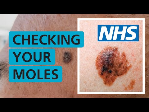 Skin Cancer - How do I check if my mole is skin cancer? | NHS | ERGSY